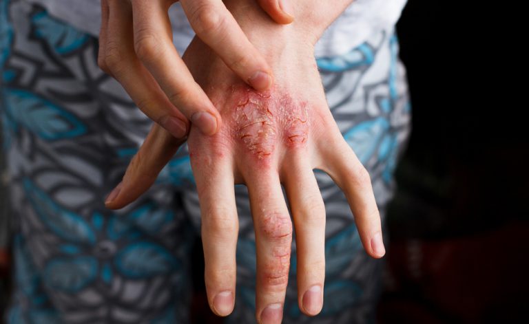 Dermatite da contatto: come prevenire e curare il fastidioso eczema ...